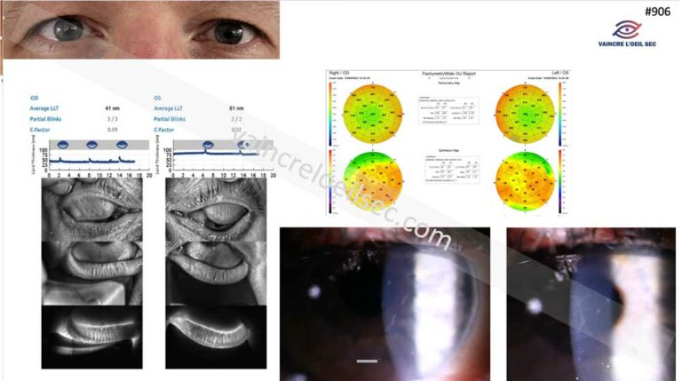 La Dystrophie de Cogan en Cas Cliniques Commentés - Vaincre l'Oeil Sec